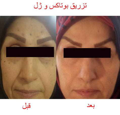 Botox Cosmetic Is A Medical Procedure That Requires Experience