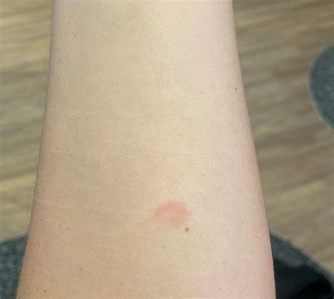 Is This Ringworm Rmedicaladvice