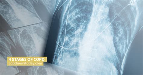 4 Stages Of Copd Copd News Today