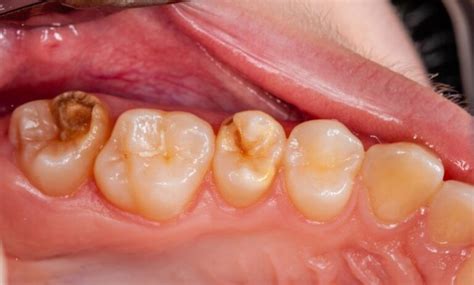 Understanding Hypomineralisation Of Teeth Causes Signs And Modern