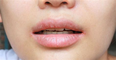 โรคปากนกกระจอก Angular Cheilitis อาการ สาเหตุ วิธีรักษา Medpark Hospital