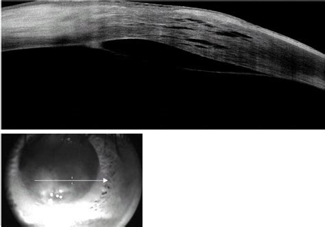 Acute Corneal Hydrops In Advanced Keratoconus Scrolller