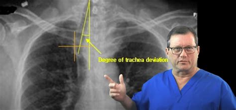 Tension Pneumothorax Acls Resources Acls Certification Association