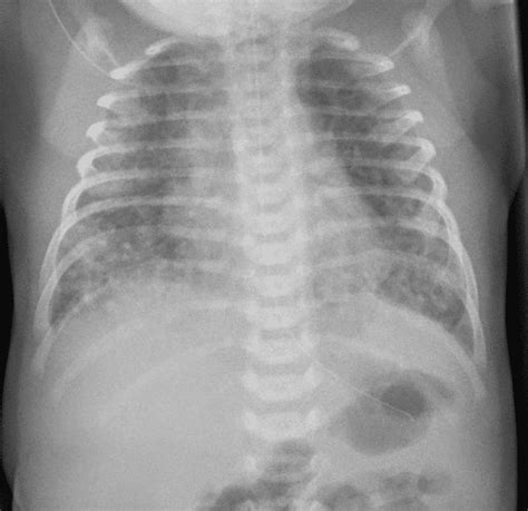 Meconium Aspiration Syndrome Investigations Teachmepaediatrics