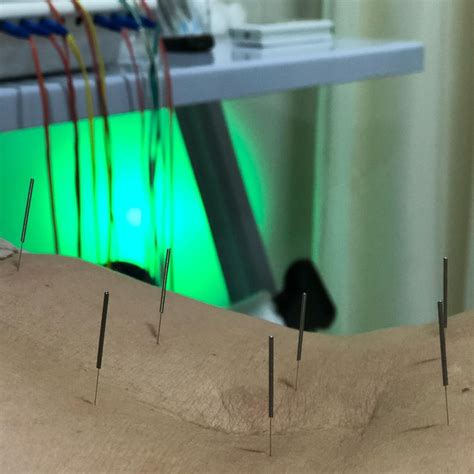 Mindra Clínica Mindra Acupuntura