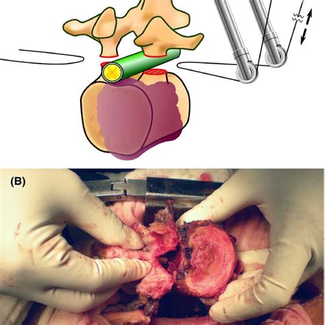 Total En Bloc Spondylectomy A Operative Schema Of Transpedicular Download Scientific Diagram