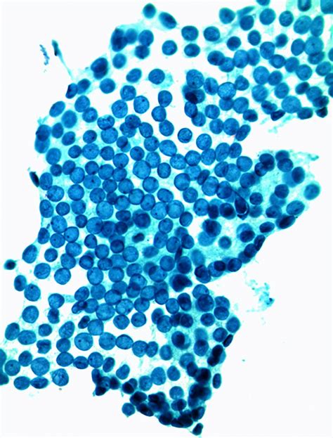 Ask The Pathologist Negative Pap But Positive Hpv Incyte Diagnostics