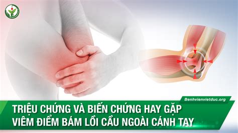Viêm điểm bám lồi cầu ngoài cánh tay Hội chứng Tennis elbow Triệu chứng và biến chứng hay gặp