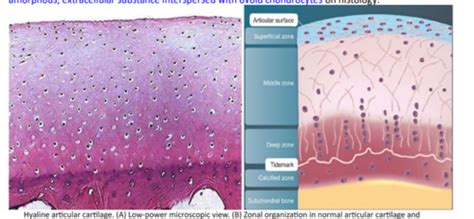 Block 2 Lecture 11 Osteoarthritis Flashcards Quizlet