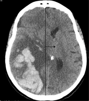 Cranial Ct Scan Right Parietal Occipital Hematoma With Cerebral Oedema