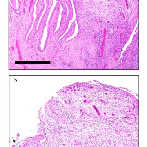 Histological Image Demonstrating Papillary Hyperplasia And An Polyp A