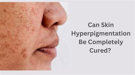 Can Skin Hyperpigmentation Be Completely Cured Lim Clinic And Surgery