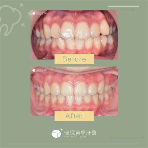 跟暴牙說再見，還我漂亮齒列｜牙齒矯正範例 恆悅美學牙醫診所
