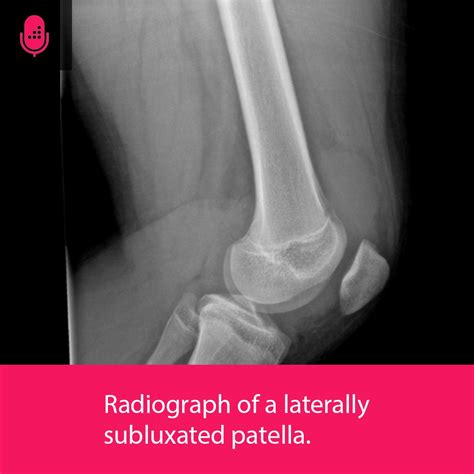 Orthobullets Patellar Instability Is A Condition Facebook