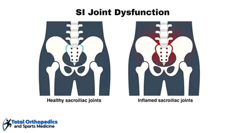 Can Si Joint Dysfunction Cause Bowel Problems Total Ortho Sports Medicine