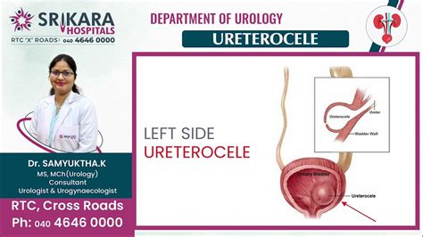 Ureterocele Figure 3 From Prolapsing Ectopic Ureterocele Presenting As
