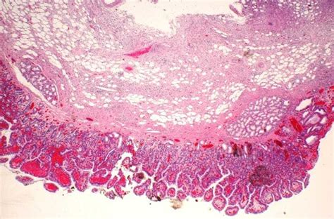 Inflammatory Fibroid Polyps Ifp Or Vanek Tumors Of The Gi Tract