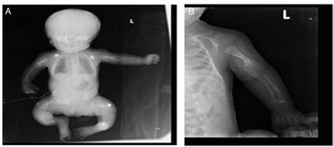 Osteogenesis Imperfecta Type 2 Ultrasound
