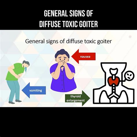 General Signs Of Diffuse Toxic Goiter Endocrinology Basedow Thyroid