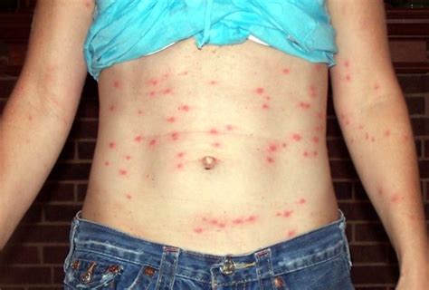 Chigger Bite Treatment Outdoor Life