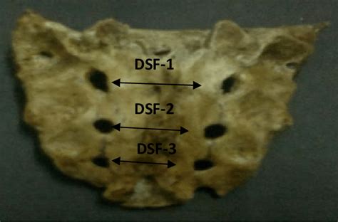 Dorsal Surface Of Sacrum Dsf 1 First Pair Of Dorsal Sacral Foramina