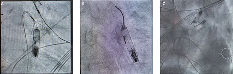 Femoral Access Retrieval Of Dislodged Leadless Pacemaker From The