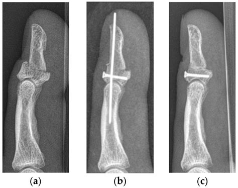 Characteristics And Therapy Of Jersey Finger Type V Injuries At A