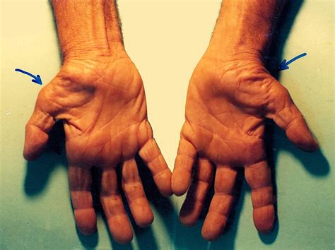 Carpal Tunnel Syndrome Wikipedia