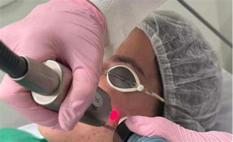 Fotona O Melhor Laser Para Acne Dra Alessandra Drummond