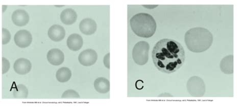 Alterations Of Erythrocyte Platelet And Hemostatic Function