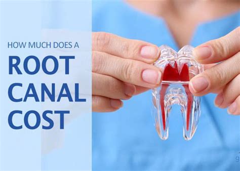 How Much Does A Root Canal Cost Dentist In Marysville