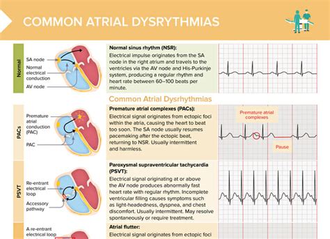Dysrhythmias Free Cheat Sheet Lecturio Nursing