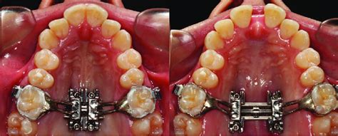 Occlusal Views Before And After Expansion With Marpe Download Scientific Diagram