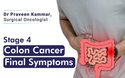 Colon Cancer Different Types Symptoms And How Its Treated