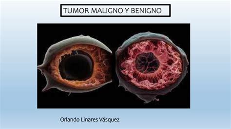 Clase 2 Tumor Maligno Y Benignopptx Introducción Pptx
