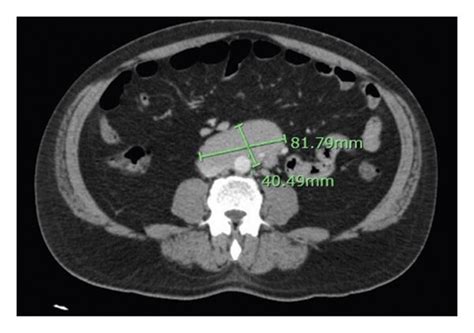 Ct Abdomen And Pelvis With Contrast Showing Enlarged Preaortic Lymph