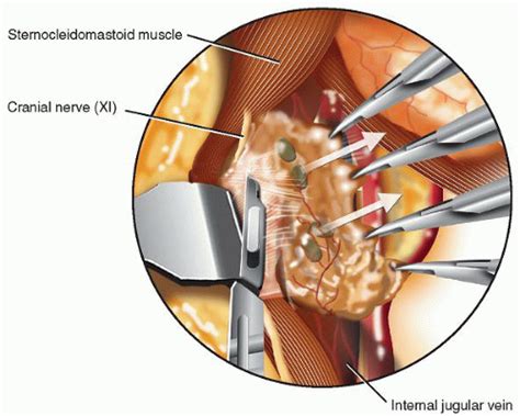 Selective Neck Dissection Ento Key