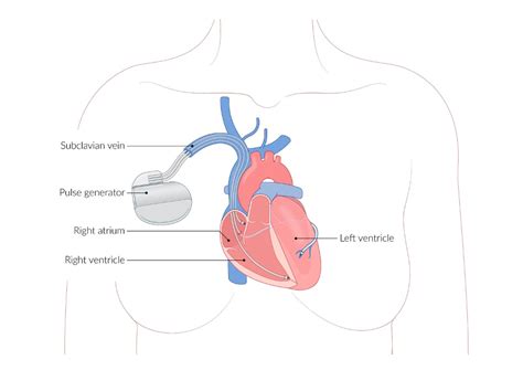 Critical Care Device Series Cardiac Implantable Electronic Devices