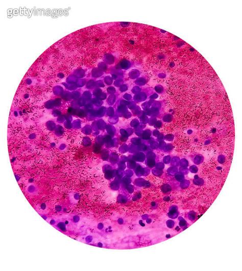 Lungs Adenocarcinoma Malignant Cell Smear Show Cellular Material Of