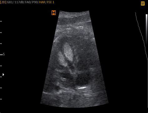 Two Fetal Left Ventricular Papillary Muscle Echogenic Mass