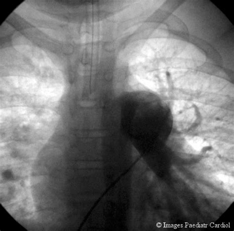 An Nih Catheter Was Placed In The Mpa And An Angiogram Performed Download Scientific Diagram