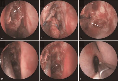 Surgical Techniques Of Endoscopic Endonasal Reduction A After