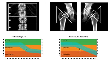 Dexa Scan Everything You Need And Want To Know