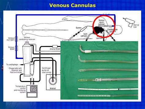 Extracorporeal Circulation Cpb Ecmo Ppt