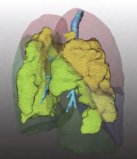 11 Three Dimensional Visualization For A Patient With Severe Lung