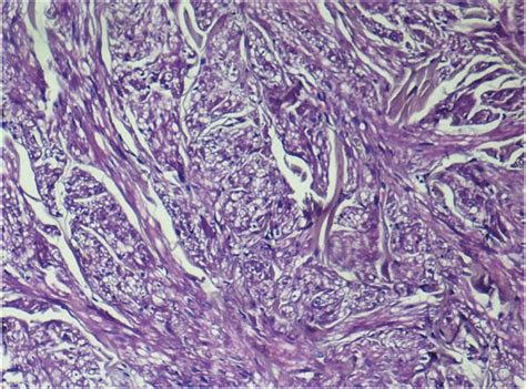 Higher Magnification View Of Cutaneous Leiomyoma Showing Smooth Muscles
