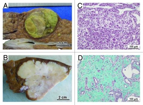 Figure 3 Hepatocellular Carcinoma And Cholangiocarcin Open I