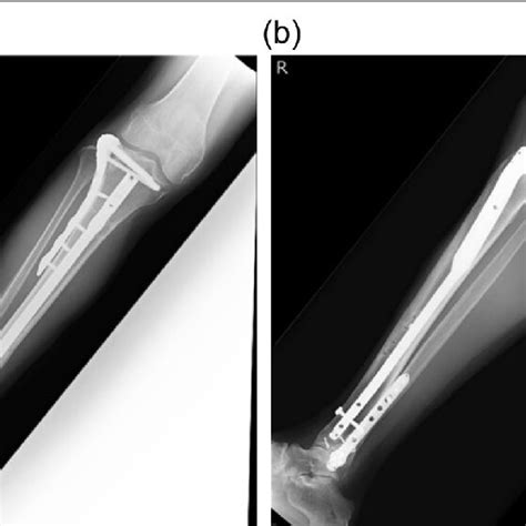 A Frontal And B Lateral X Rays Of The Right Tibia After Bone Fixations