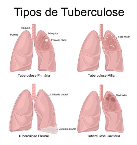 Tuberculose O Que Preciso Saber
