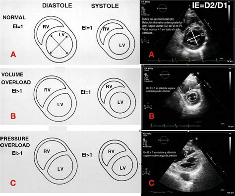 Right Ventricular Dysfunction In The Critically Ill Echocardiographic